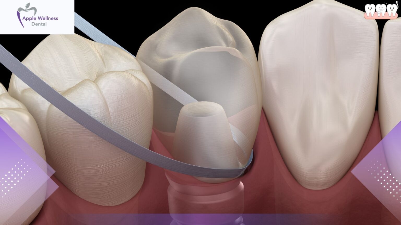 Learn How To Clean Dental Implants Effectively