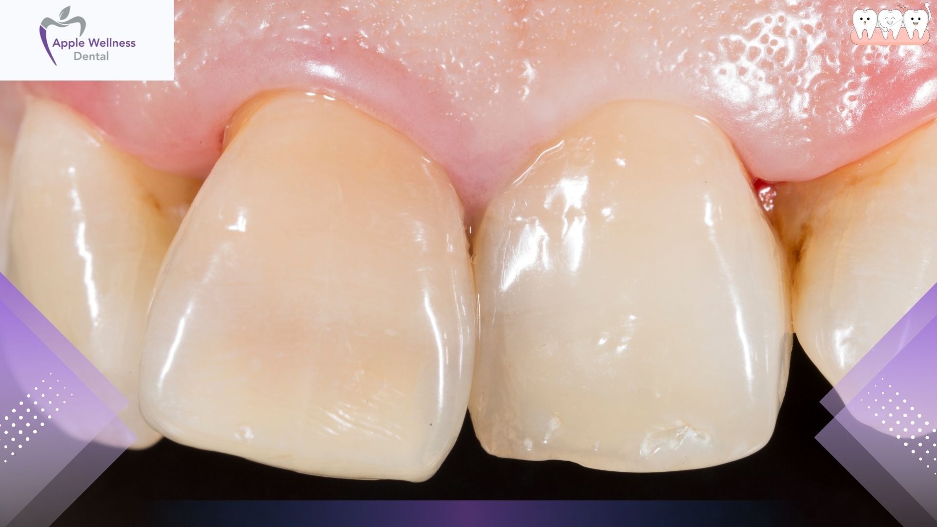 Discover What Is Gingival Hyperplasia And Its Oral Health Effects